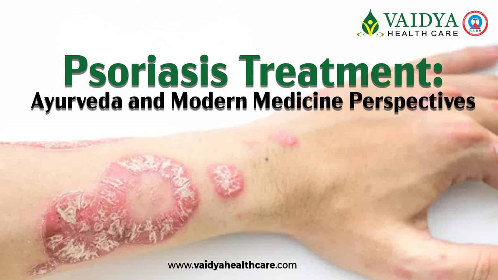 Psoriasis Treatment: Ayurveda vs. Modern Medicine Approaches