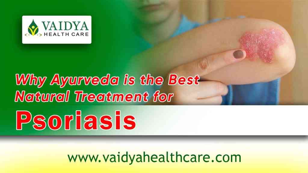 Why Choose Ayurveda for Psoriasis Treatment in India
